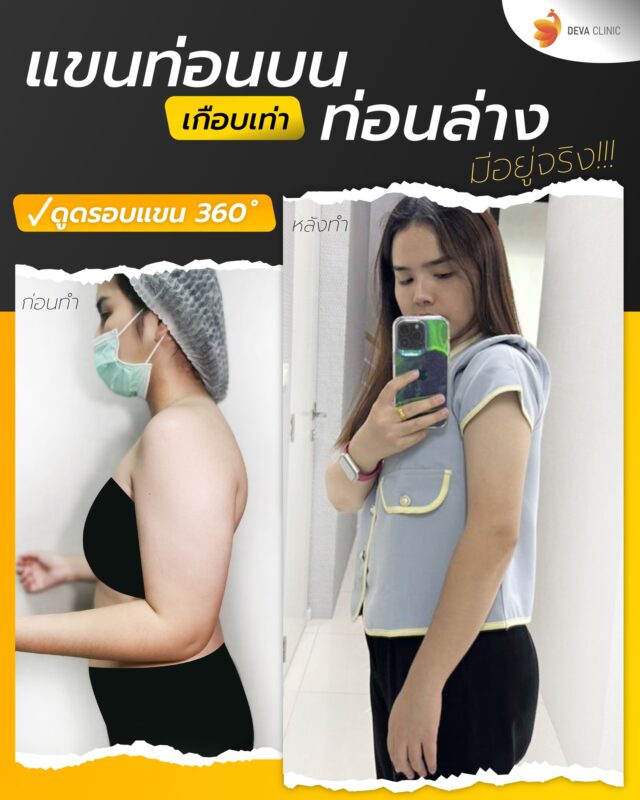 Promotion - Deva clinic